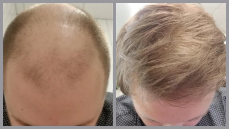 Peak Mens Health | Hair Loss Treatment | ED+PE Treatment | Online
